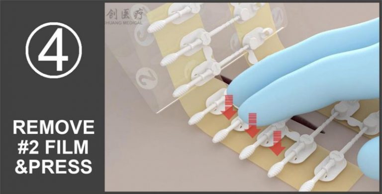 How to Use BI-FIX Surgical Incision Closure Set - Haichuang Medical