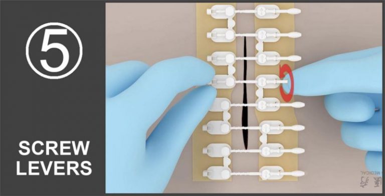 How to Use BI-FIX Surgical Incision Closure Set - Haichuang Medical