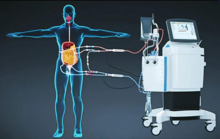HIPEC Procedure and LOOPIX Wound Drainage Tube Fixing Device