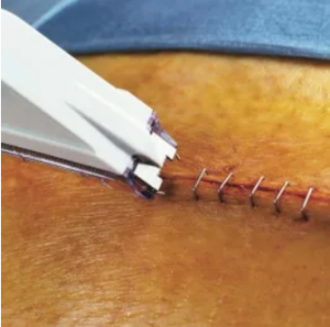 Wound Closure with Suture and Sutureless Methods: Today and in History ...