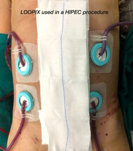 HIPEC Procedure and LOOPIX Wound Drainage Tube Fixing Device